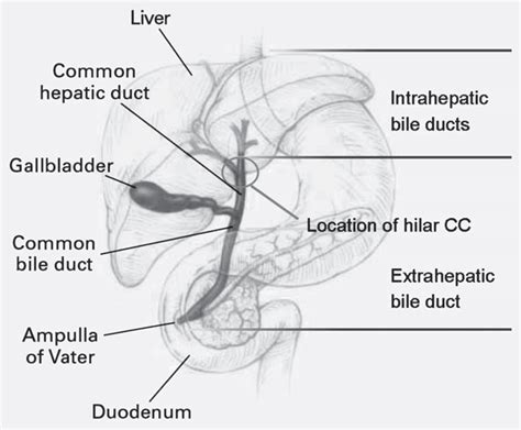 Extrahepatic Cholangiocarcinoma Semantic Scholar