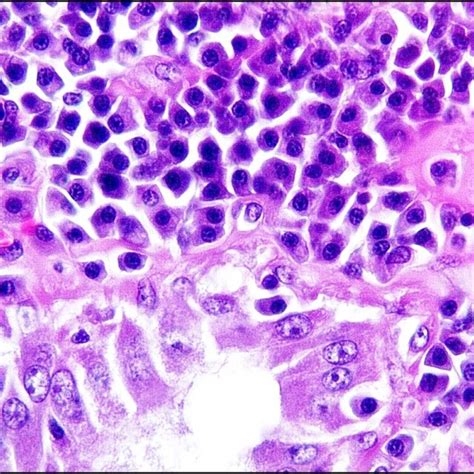 Atypical Plasma Cells Between Anaplastic Sweat Glands Hxe X100 Şekil