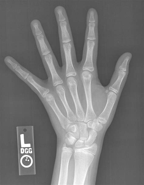 Python Adjusting And Improving X Ray Images Contrast And Its Quality Stack Overflow