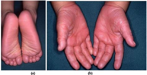 Figure 2 From Hereditary Palmoplantar Keratosis Semantic Scholar