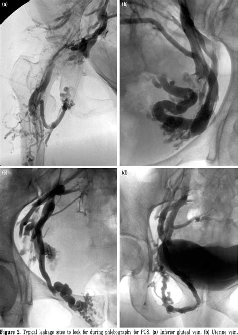 Figure 2 From Management Of Pelvic Venous Disorders Semantic Scholar