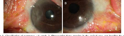 Figure 1 From Effectiveness Of Mitomycin C Combined With Amniotic Membrane Transplantation To