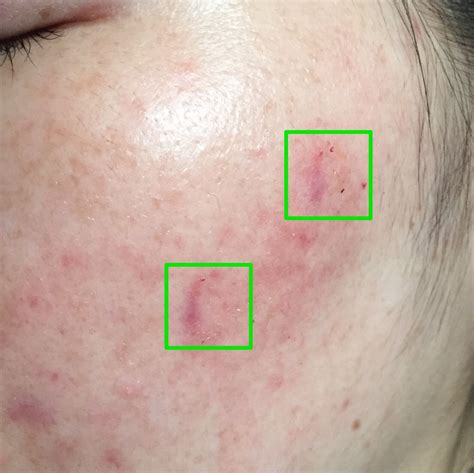 셀라스서브시전도트필2차2회시술일주일 네이버 블로그