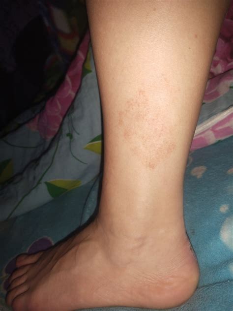 Появилось пятно на ноге Появилось пятно на ноге иногда чешется больше Medaboutme