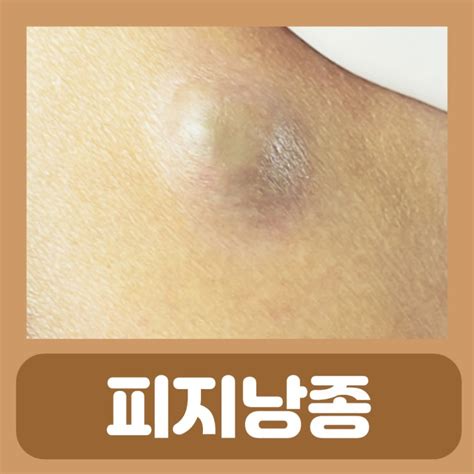 피지낭종 수술 후 제거 후기 발바닥 두피 겨드랑이 피지낭종 원인 네이버 블로그