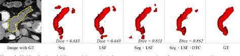 Figure 2 From Semi Supervised Medical Image Segmentation Through Dual Task Consistency
