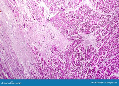 Acute Myocardial Infarction Histology Of Heart Tissue Royalty Free Stock Image Cartoondealer