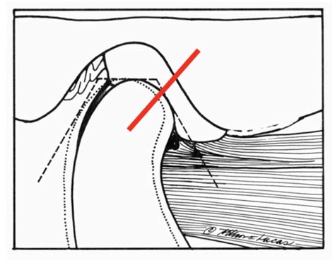 L9 Optical Functional Occlusion I II Flashcards Quizlet