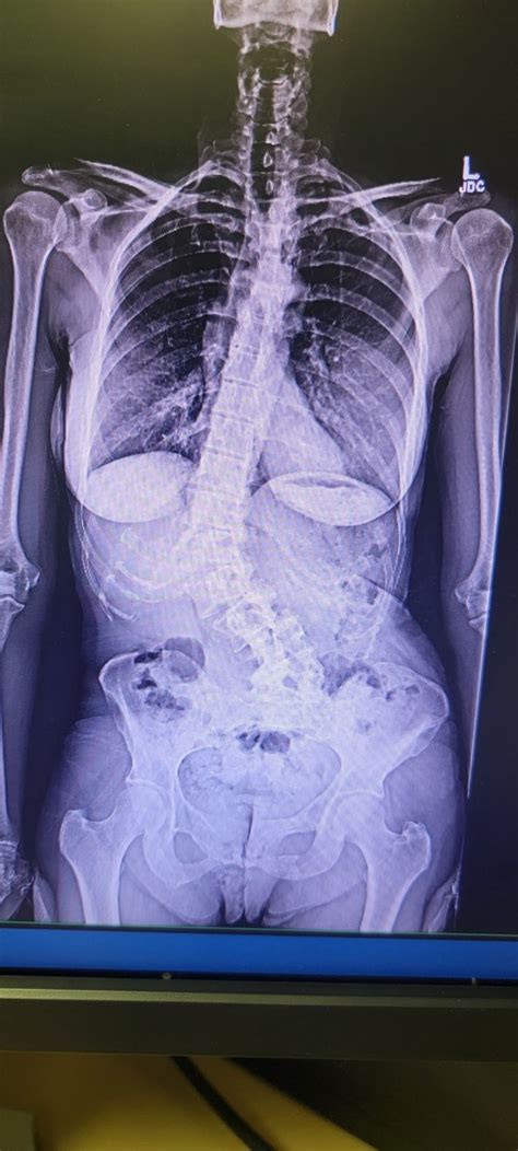 Varun Singh Md On Linkedin Scoliotic Deformity Of Thoracolumbar Spine Pre Op And Post Op