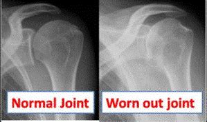 Shoulder Arthritis