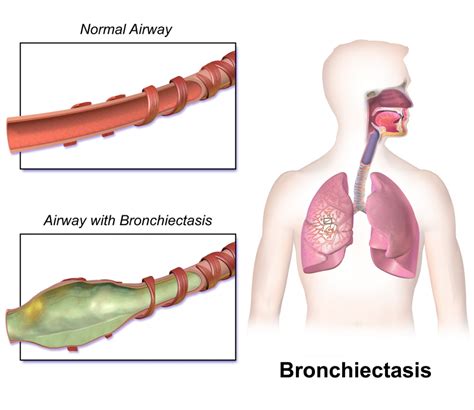 Bronchiectasis Severe Asthma Toolkit