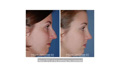 Recovery From Rhinoplasty Widening A Narrow Nose Video Realself