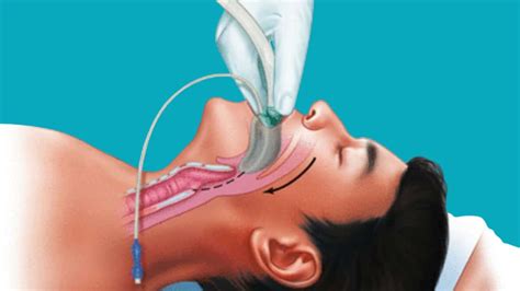 Laryngeal Mask Airway Unveiling The Lma