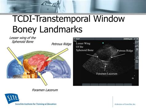 Ppt Introduction To Transcranial Doppler Tcd Powerpoint Presentation Id 6593313