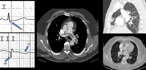 Types Of Pulmonary Embolism Saddle