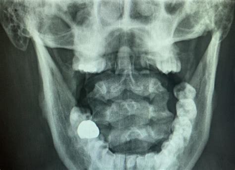 3 Vertebrae Odontoid For Your Viewing Pleasure I Did Not Take This Film My Coworker Who Doesn