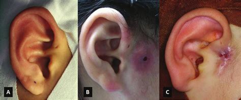 Preauricular Pit Infection
