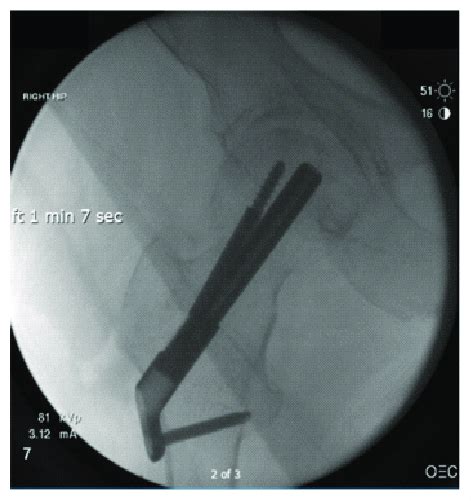 Intraoperative Ap Radiograph Showing Final Implant Position Download Scientific Diagram