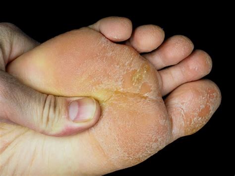 Why Are My Big Toenails Peeling Off At Bridget Mireles Blog