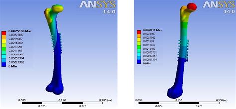 Figure 5 From Finite Element Analysis Of Femur Fracture Fixation Plates