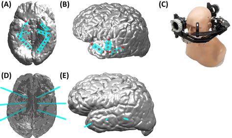 Example Data 3d Reconstruction Of The Postoperative Location Of