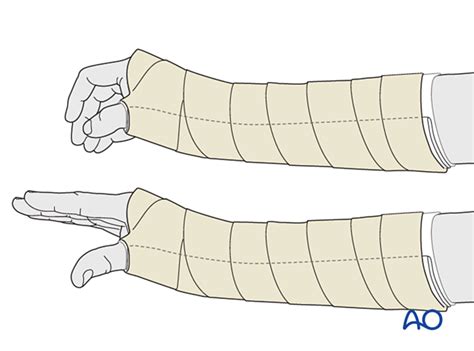 Closed Reduction Splinting Preliminary Treatment For Lunate Dislocation