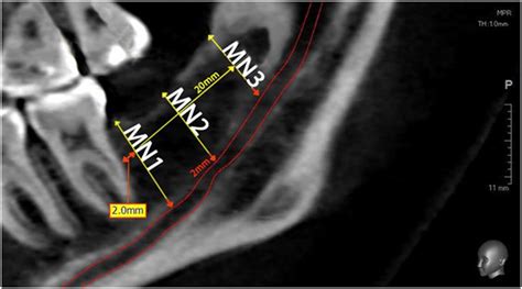 Sagittal Section Of Retromolar Region In Cone‐beam Computed Tomogram Download Scientific
