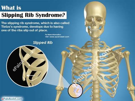 13 Slipping Rib Syndrome Ideas Chest Pain Syndrome Abdominal