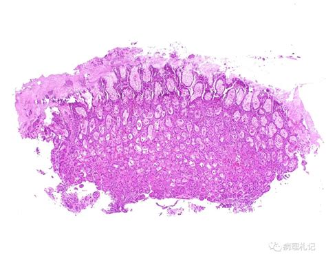 病理视角 可以在内镜下伪装成结直肠腺瘤 医学界 助力医生临床决策和职业成长