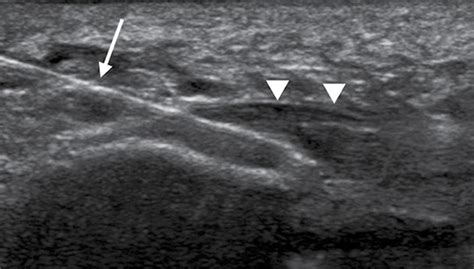 Ultrasound Guided Procedure Effective For Treating Plantar Fasciitis