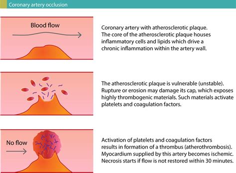 Diagnostic Criteria For Acute Myocardial Infarction Cardiac Troponins