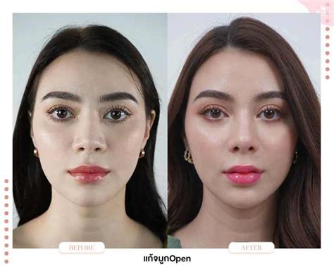 Nose Reduction Surgery Enhancing Facial Harmony YKJ Medical Center