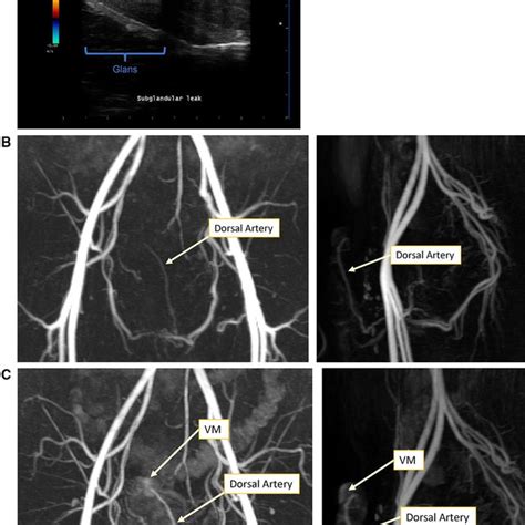 Abnormal Course Of Right Cavernosal Artery Connecting With A Download Scientific Diagram