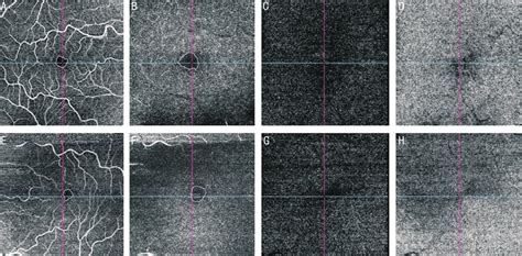 Oct Angiography Of The Right A D And Left Eye E H Oct A Indicated