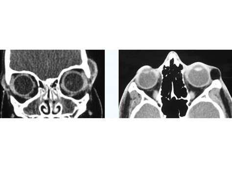 Congenital Dermoid The Dh Verity Eye Practice