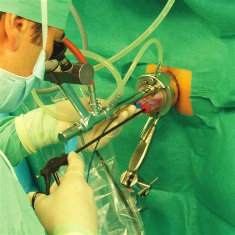 Instrument Setup Of Transanal Endoscopic Microsurgery Download