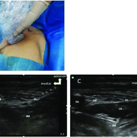 Representative Image And Ultrasound Scans Of The Patient Receiving Peng