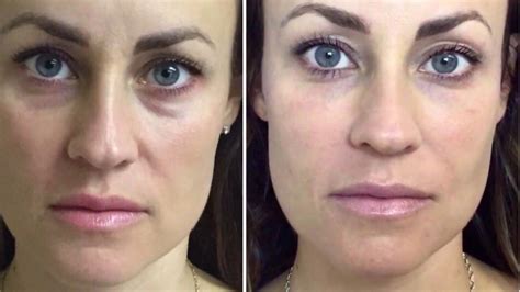 Botox Before And After Under Eyes