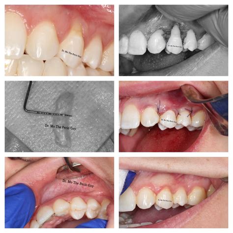 Mohammad Ahmad Javaid On Linkedin Soft Tissue Grafting The Connective Tissue Graft Ctg