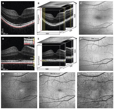 Generation Of Both Oct Fundus Images And Projection Oct Fundus Images