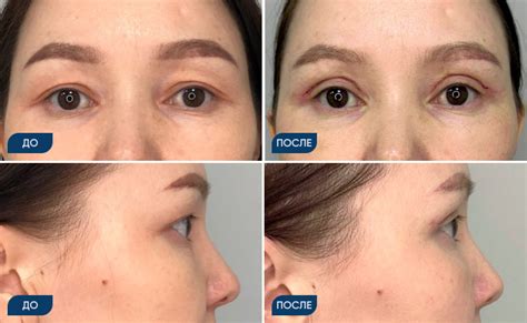 Истории пациентов блефаропластика кейс 16