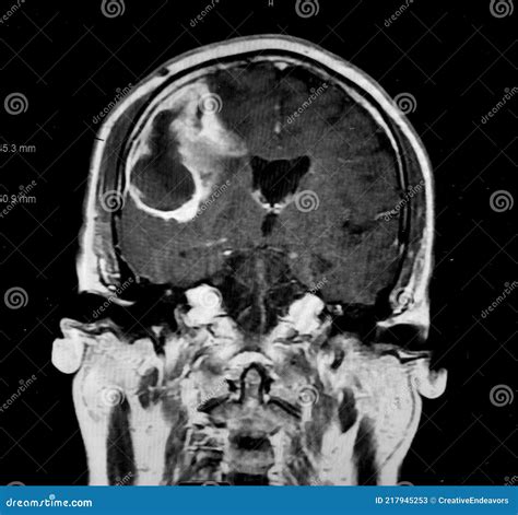 Brain Ct Showing E Coli Brain Abscess Stock Image Image Of Seizures Scan 217945253