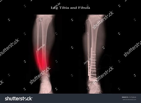 Fracture Left Leg Tibia Fibula Stock Photo 414768646 Shutterstock