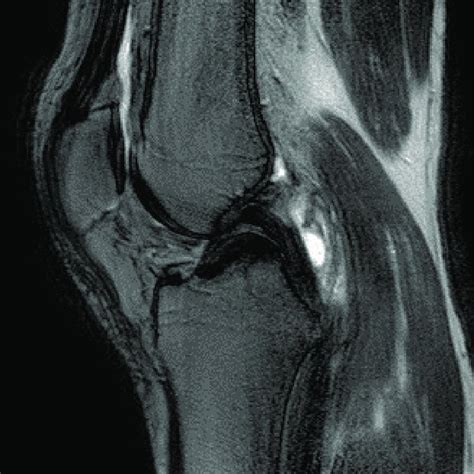 Same Case Of Figure 1 Pre Operative Mri Shows The Double Pcl Sign Download Scientific
