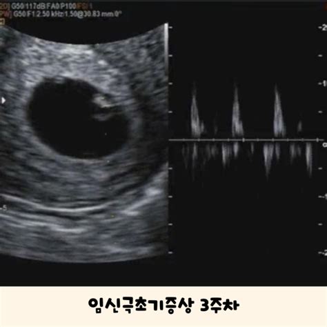 임신극초기증상 1주~4주차 주의사항 임테기 네이버 블로그 임신극초기증상 1주~4주차 주의사항 임테기 네이버 블로그