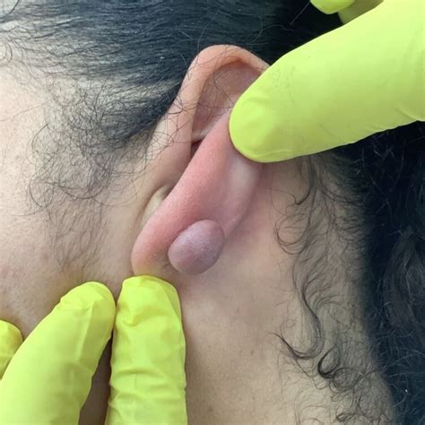 Keloid Removal Behind Ear Debulking Surgery And Steroid Treatment