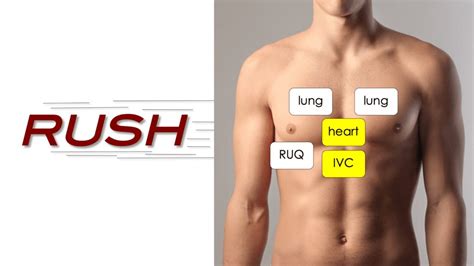 Use Pocus For The Diagnosis And Management Of Shock Clarius