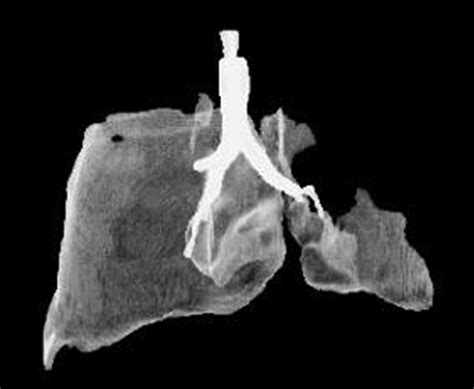 Mdct For Automated Detection And Measurement Of Pneumothoraces In