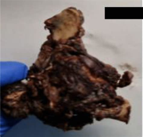 Right Segmental Mandibulectomy Showing A Tumor Resection From Tooth 20