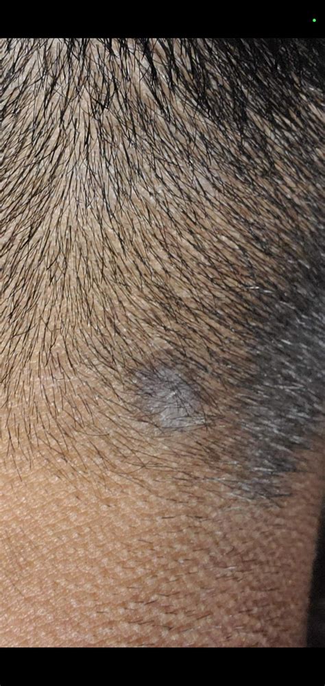 Would Like To Know If This Is A Ringworm Or Something Else Rdermatology
